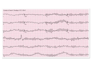 Irregular wide qrs tachycardia | PPT