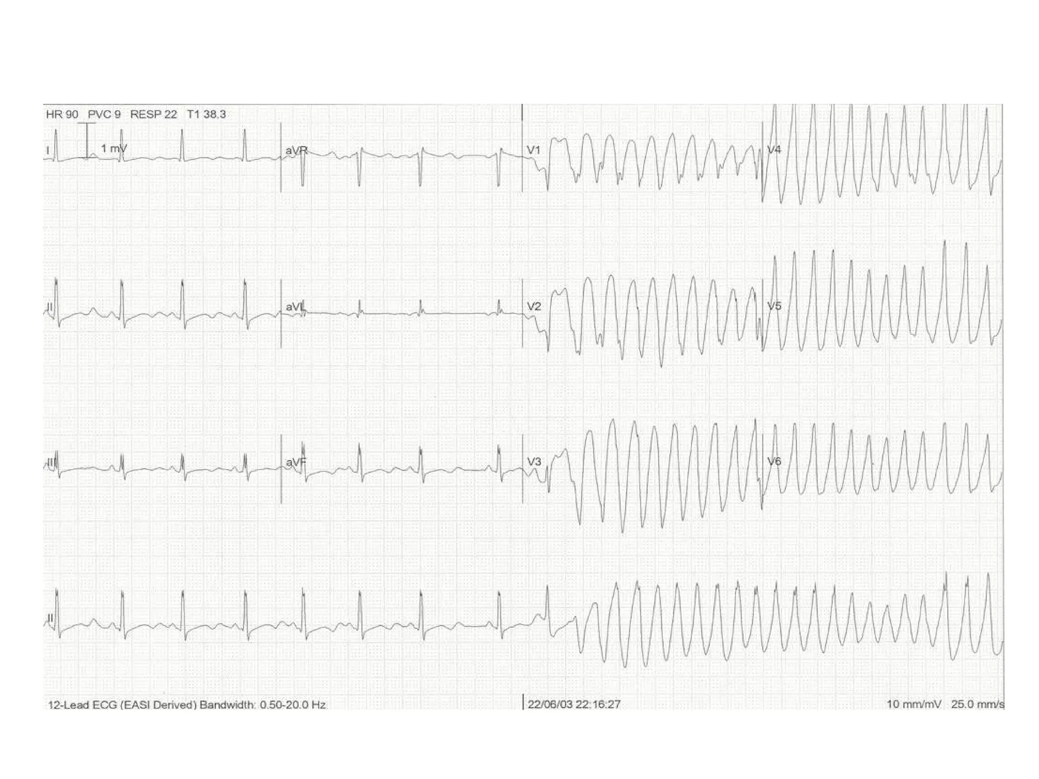 ECG: Wide QRS Tachycardia | PPT