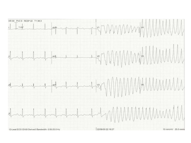 ECG: Wide QRS Tachycardia | PPT | Heart and Cardiovascular Diseases ...