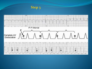 Wide complex Tachycardia by Dr. Vaibhav Yawalkar | PPT