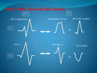 Wide complex Tachycardia by Dr. Vaibhav Yawalkar | PPT