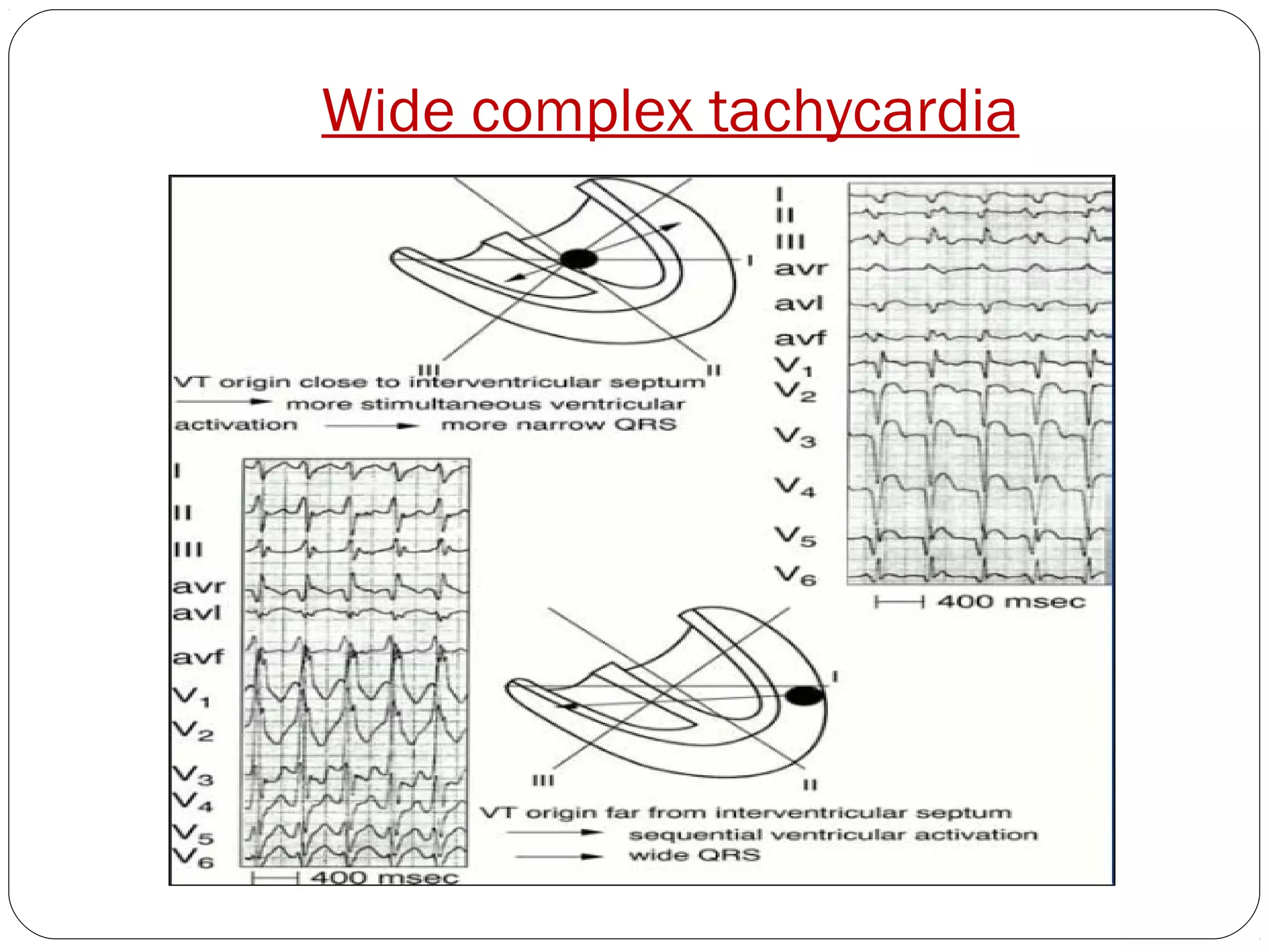 WIDE QRS TACHYCARDIA | PPT