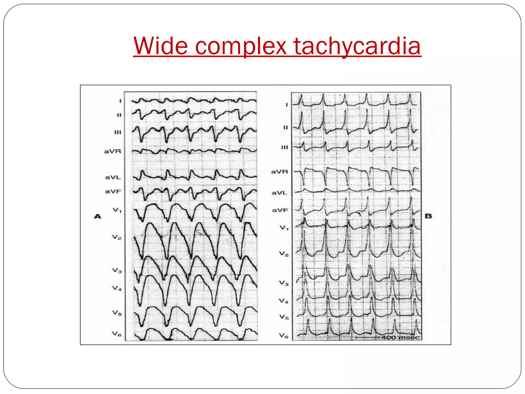 WIDE QRS TACHYCARDIA | PPT