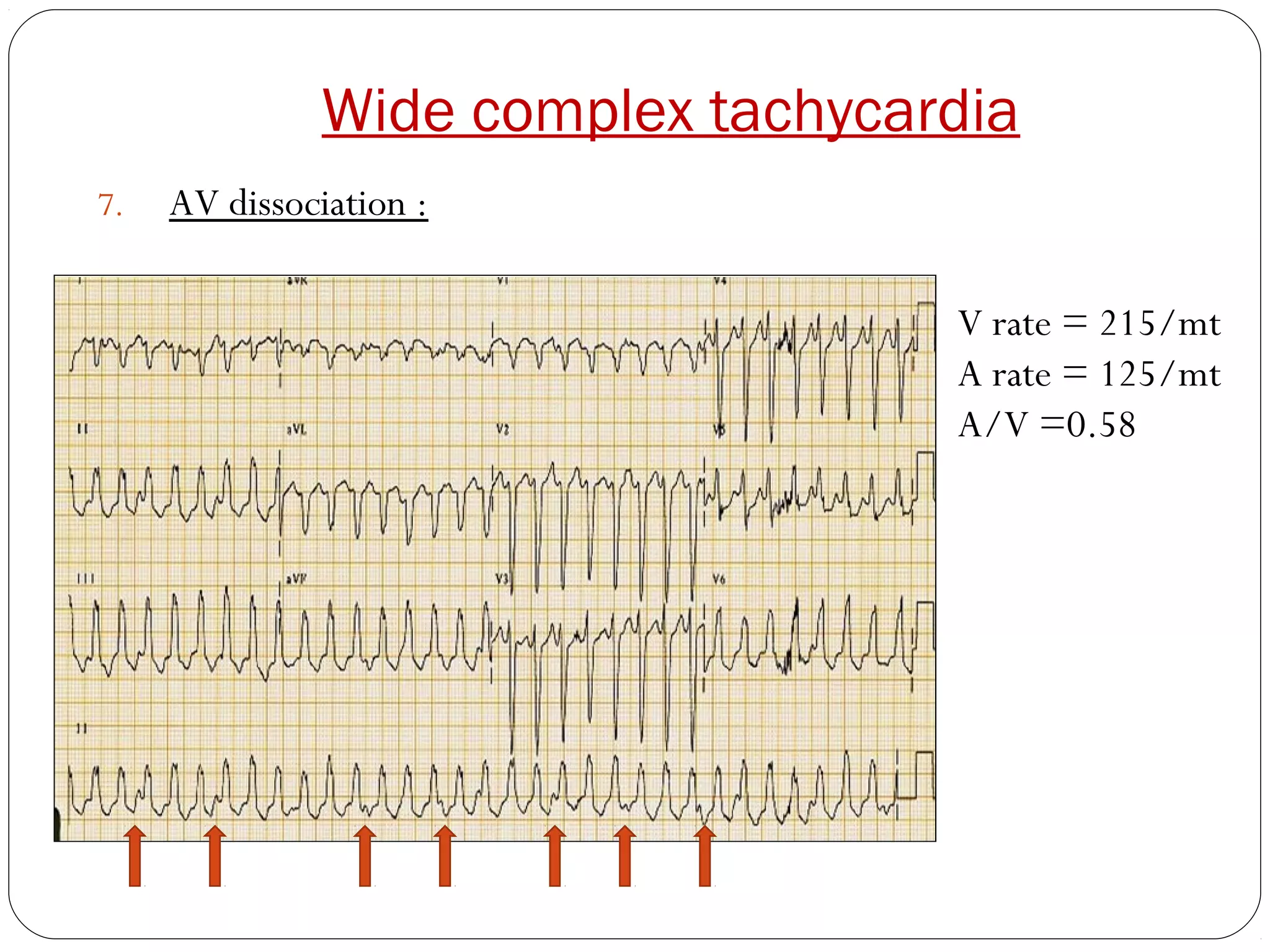 WIDE QRS TACHYCARDIA | PPT