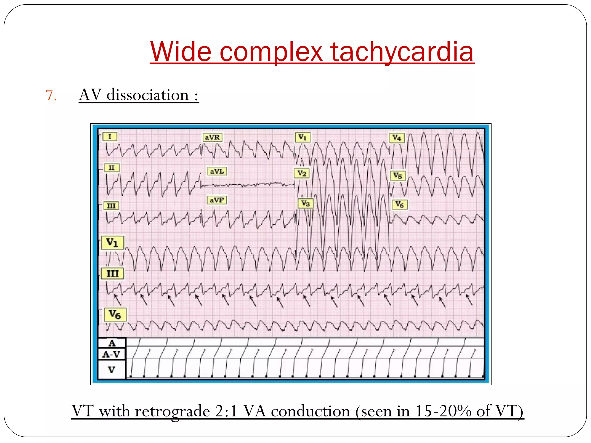 WIDE QRS TACHYCARDIA | PPT