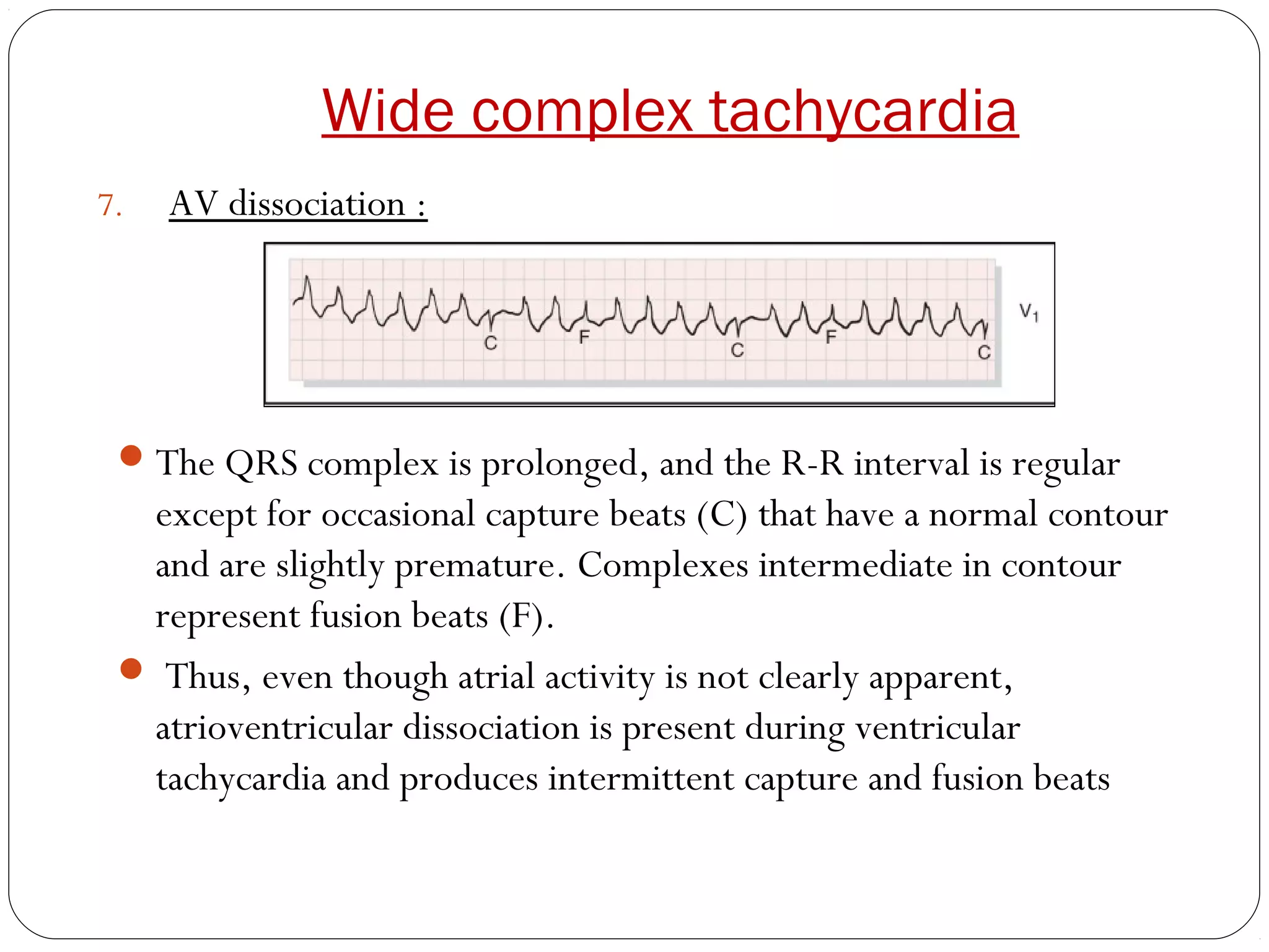 WIDE QRS TACHYCARDIA | PPT