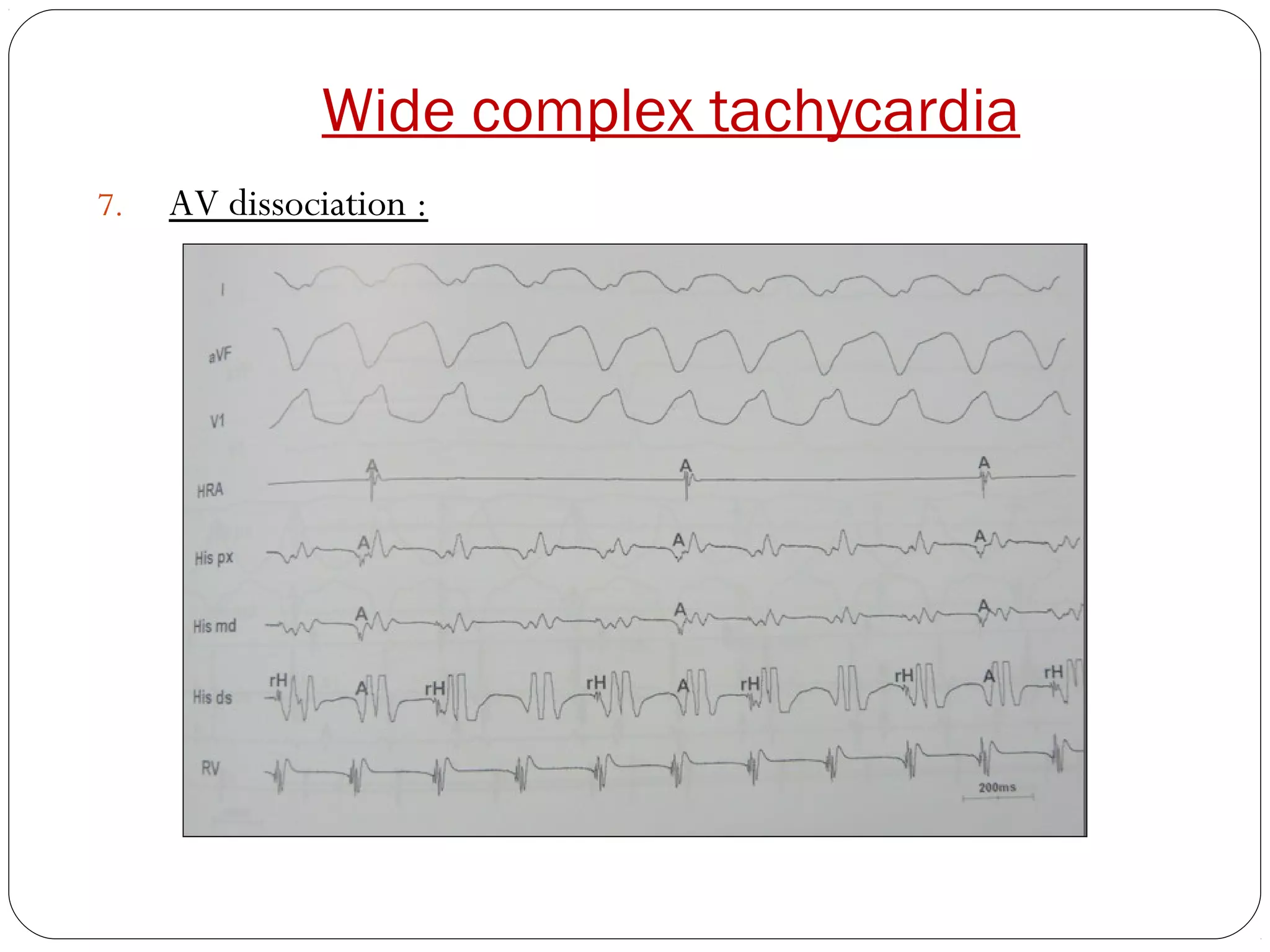 WIDE QRS TACHYCARDIA | PPT