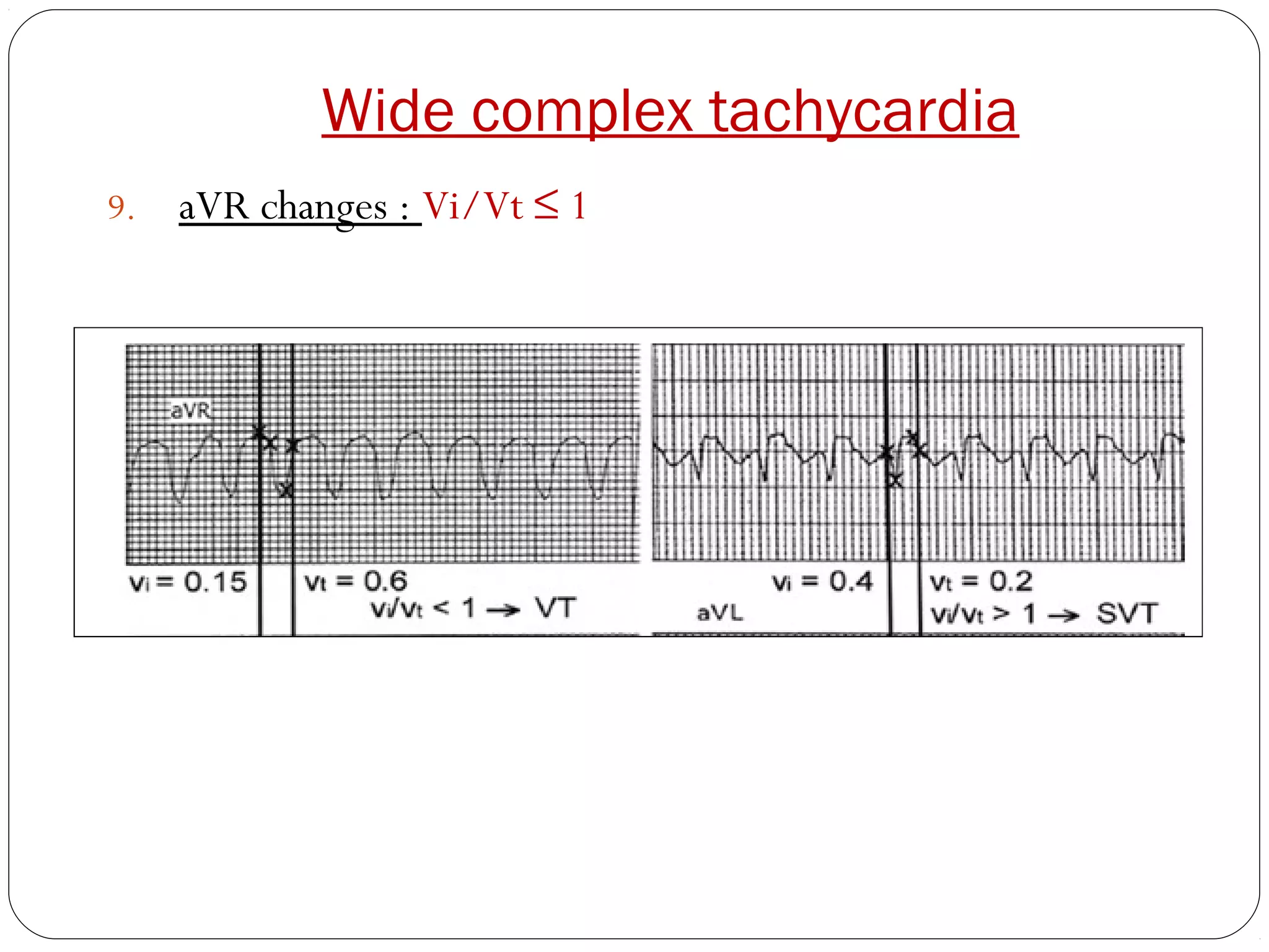 WIDE QRS TACHYCARDIA | PPT
