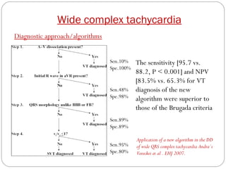 Wide Qrs Complex Tachycardia