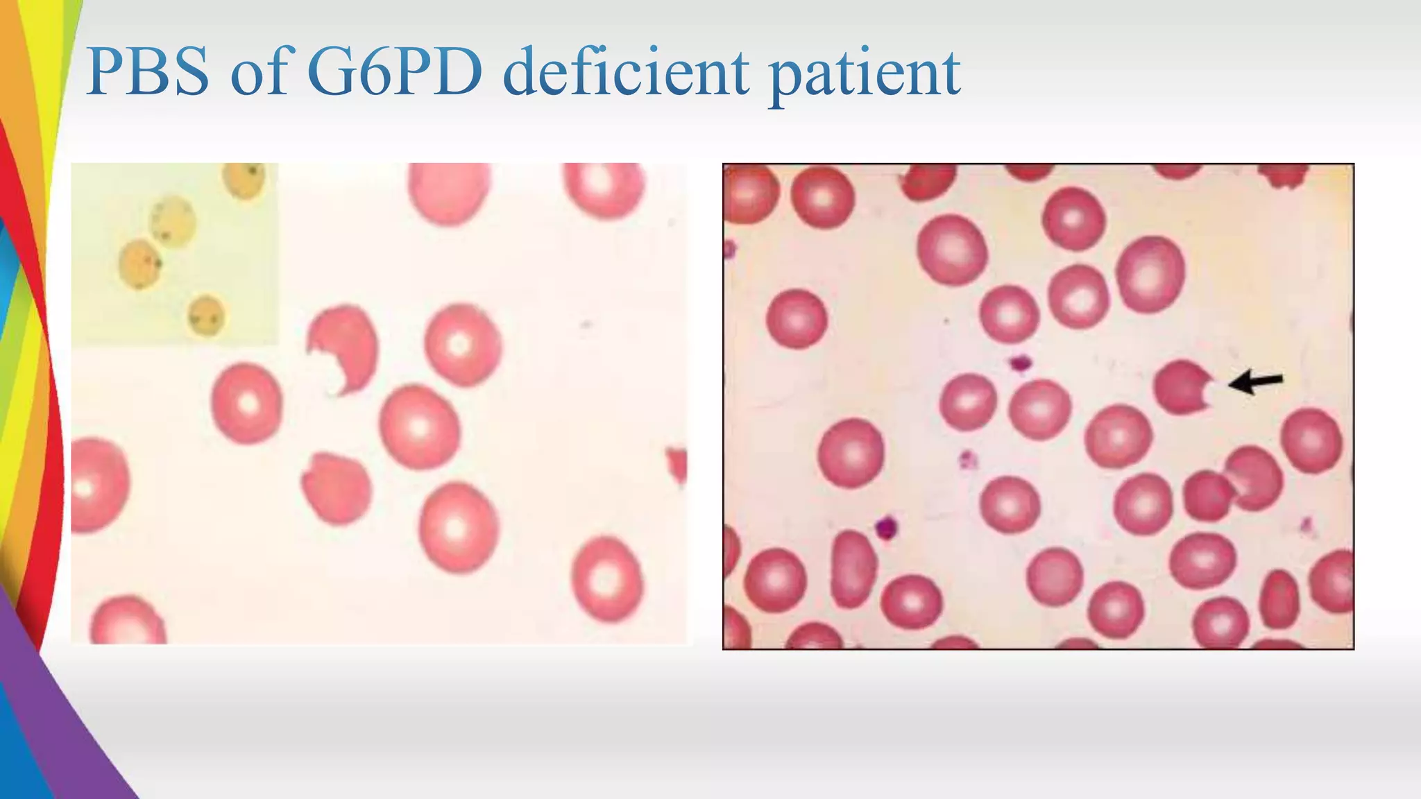 Laboratory testing of spherocytic anaemia | PPTX