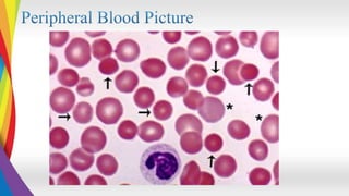Laboratory testing of spherocytic anaemia | PPTX