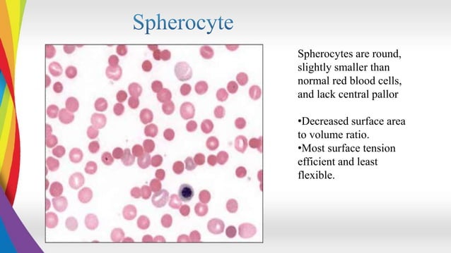 Laboratory testing of spherocytic anaemia | PPT