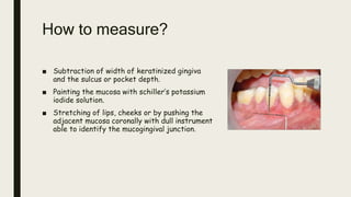 Width of attached gingiva | PPTX