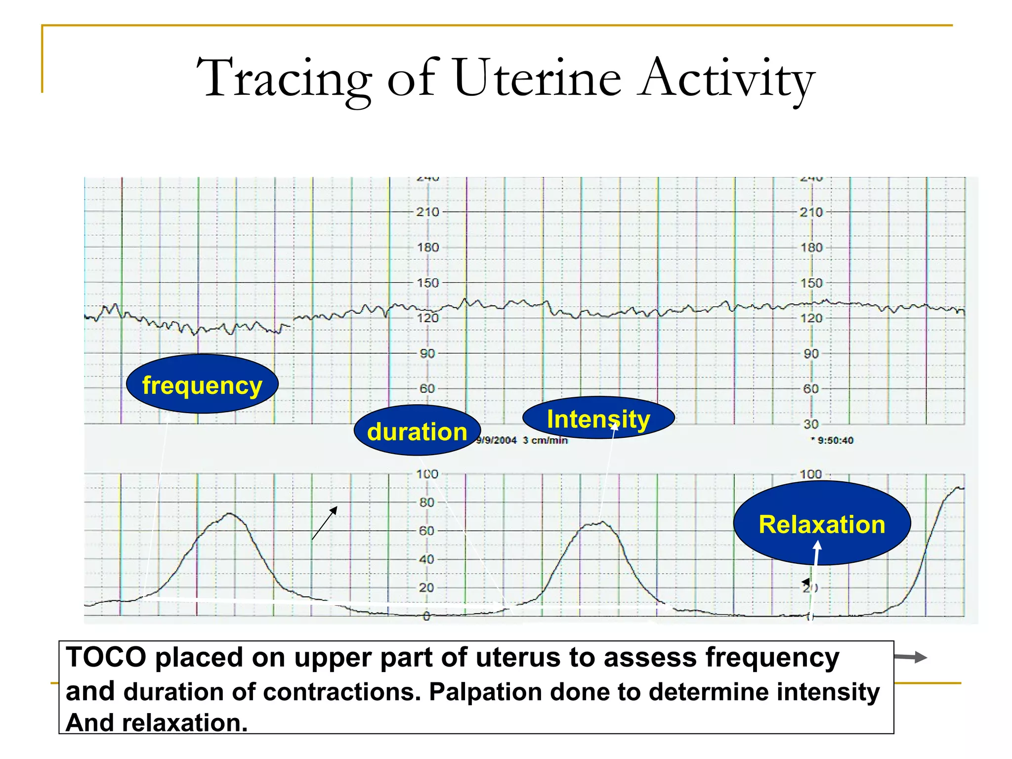 Wiki.assessment of uterine contractions 2011 | PPT