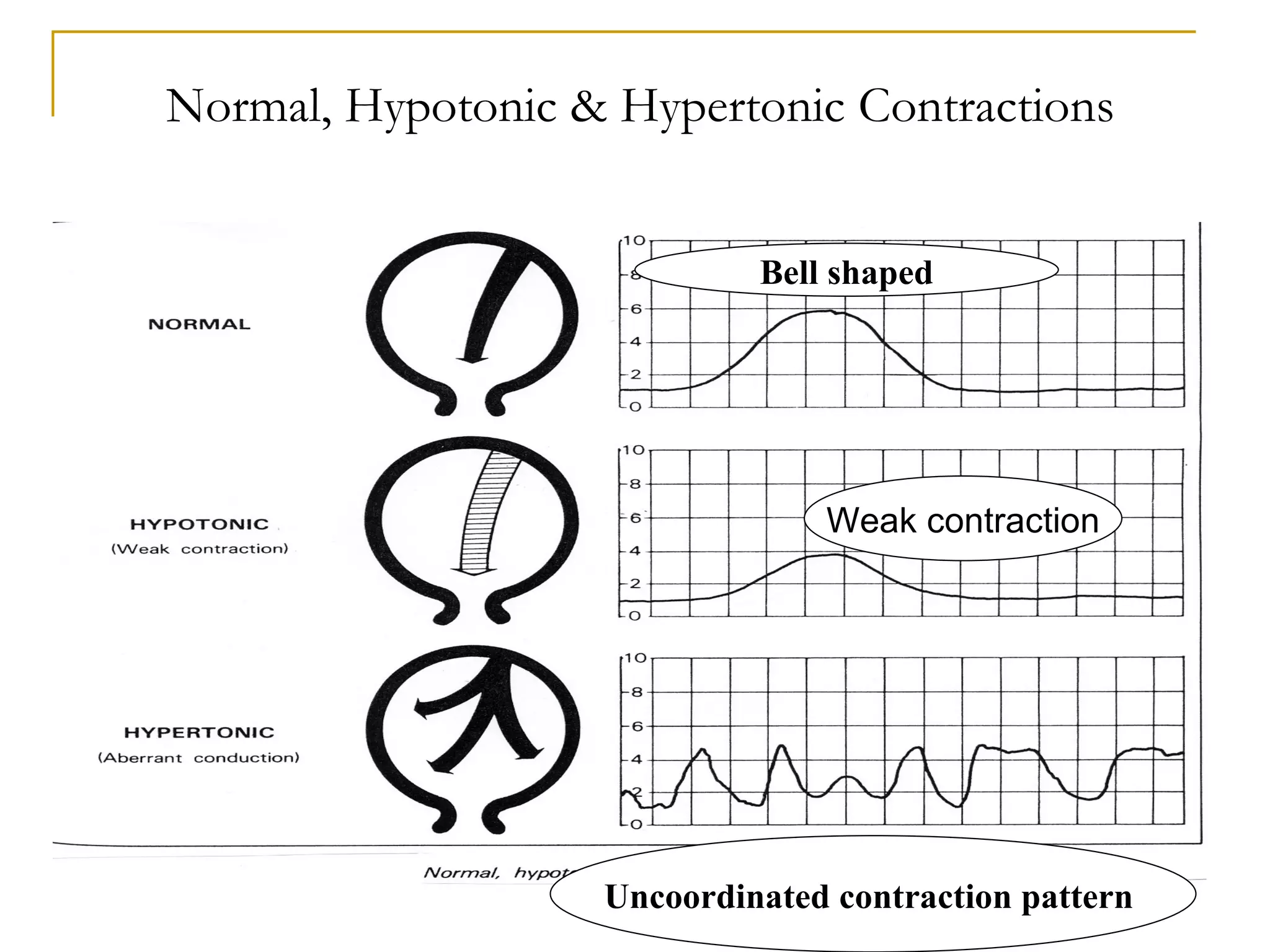 Wiki.assessment of uterine contractions 2011 | PPT