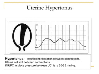 Wiki.assessment of uterine contractions 2011 | PPT