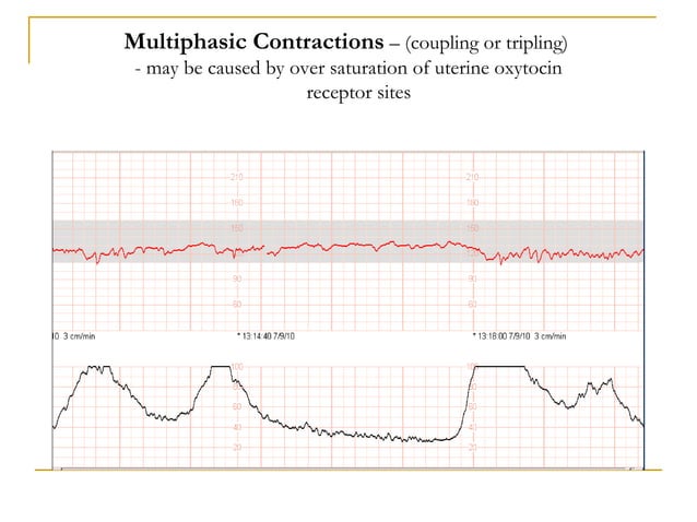 Wiki.assessment of uterine contractions 2011 | PPT | Pregnancy ...
