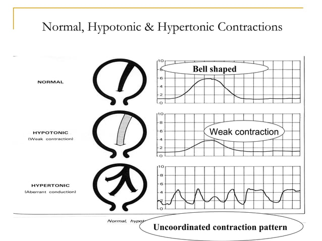 Wiki.assessment of uterine contractions 2011 | PPT | Pregnancy ...