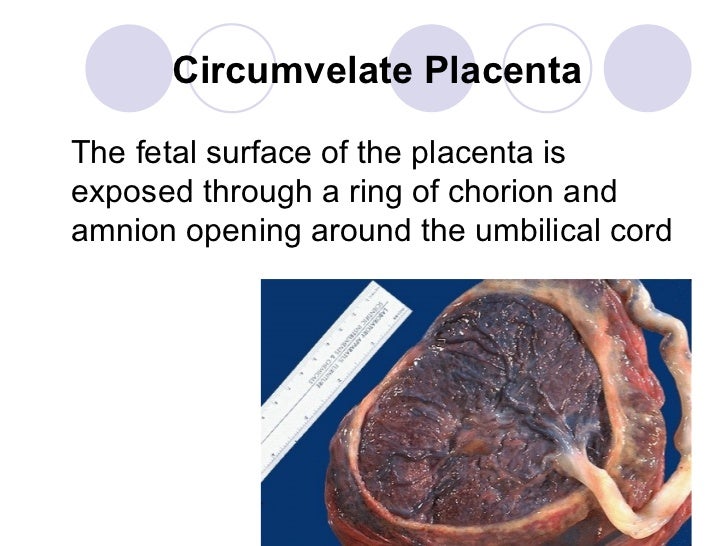 Wiki.placental abnormalities1