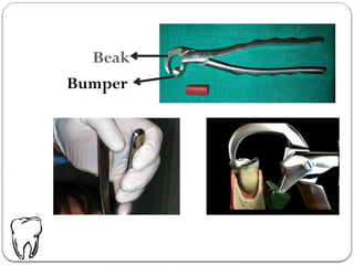 Wilckodontics the art of atraumatic extraction of tooth | PPT