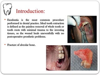 Wilckodontics and its importance in atraumatic tooth extraction | PPT