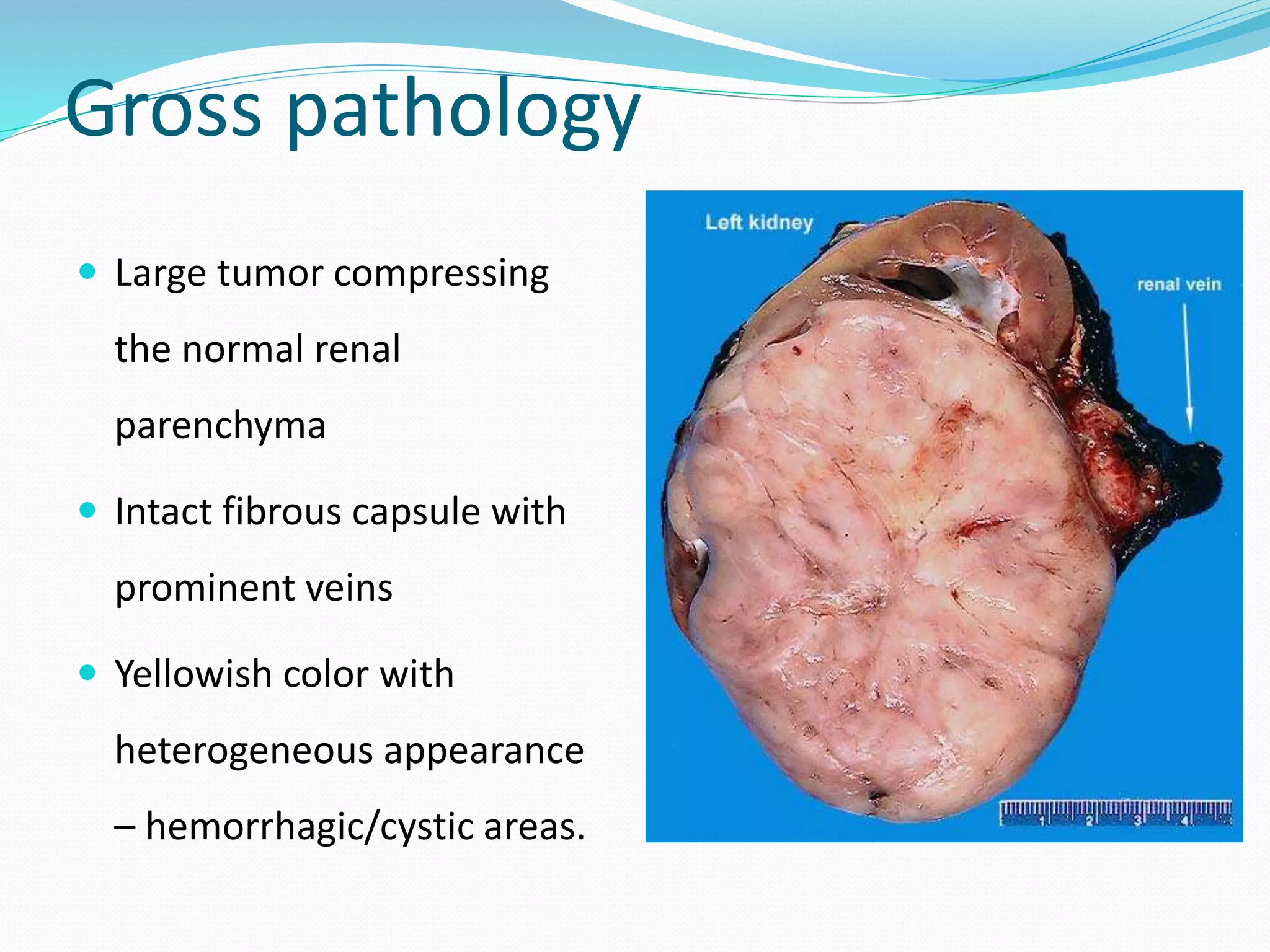 Wilms tumor | PPTX