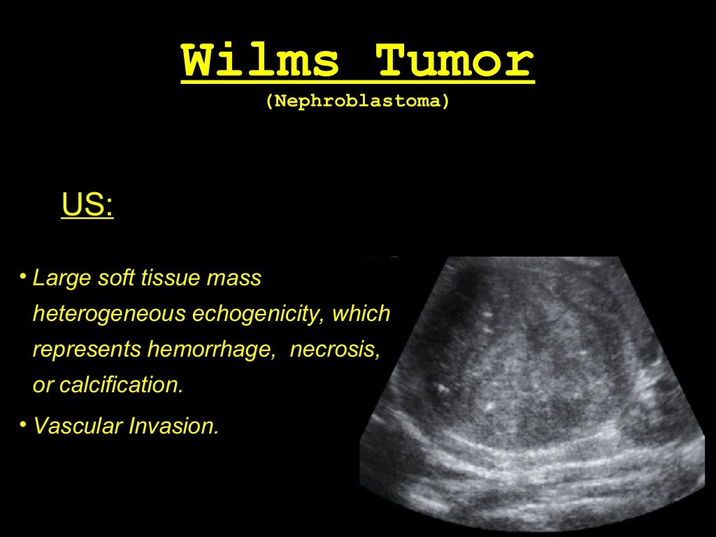 Wilms tumor