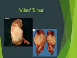 Wilms' tumor | PPT
