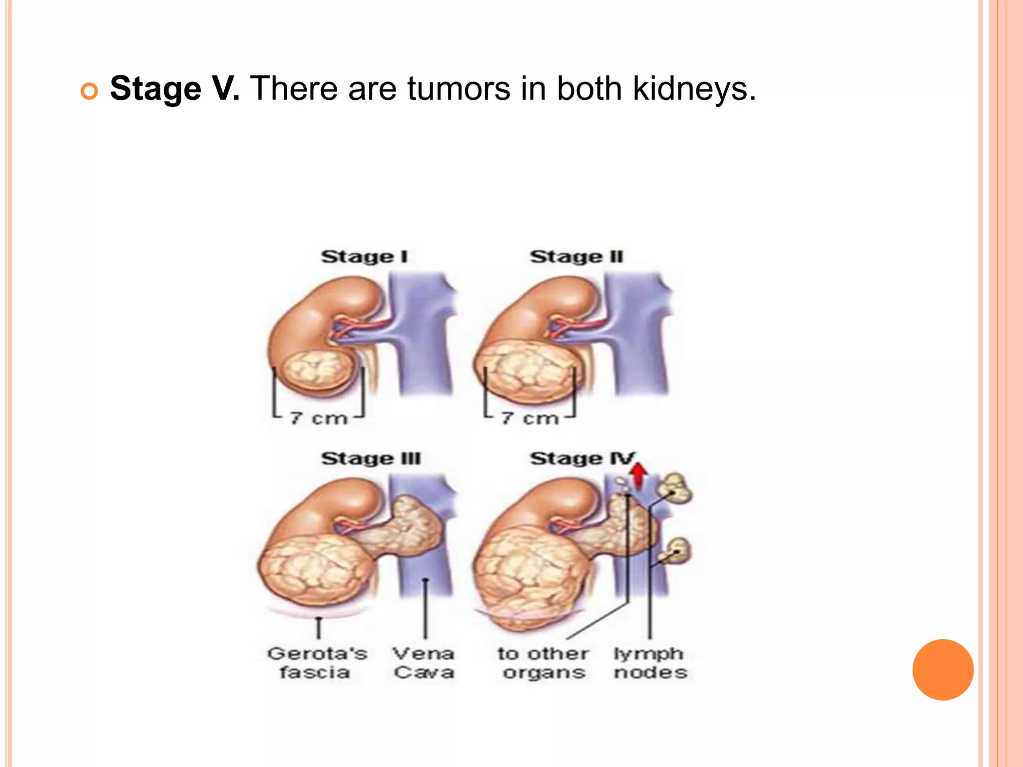 Wilms tumor.pptx