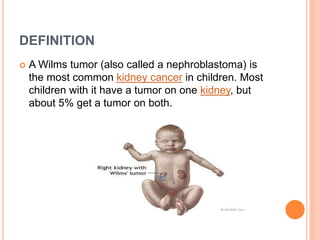 Wilms tumor.pptx