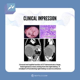 Wilm’s tumor (nephroblastoma) | DIBS by Nextillo | PDF