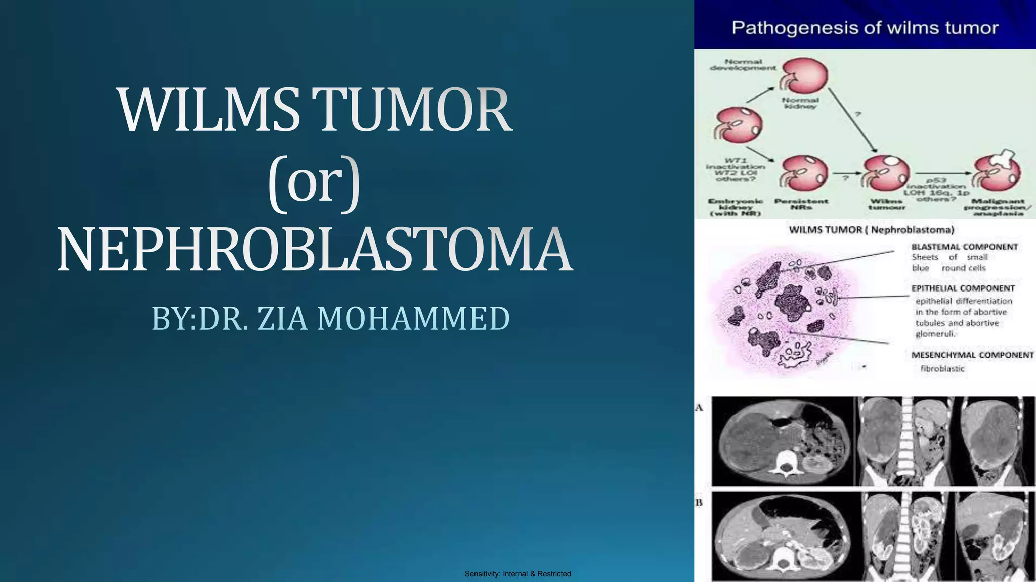 Wilms Tumor Ppt Pptx