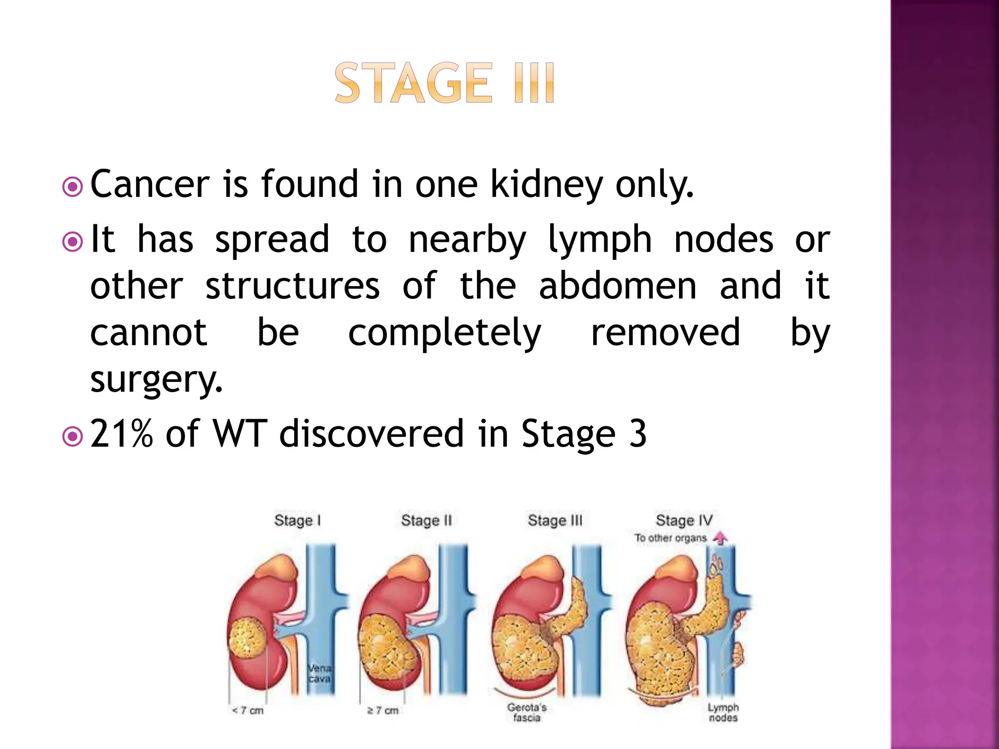 wilms tumor ppt.pptx ppt tumor wilms tumor | PPT