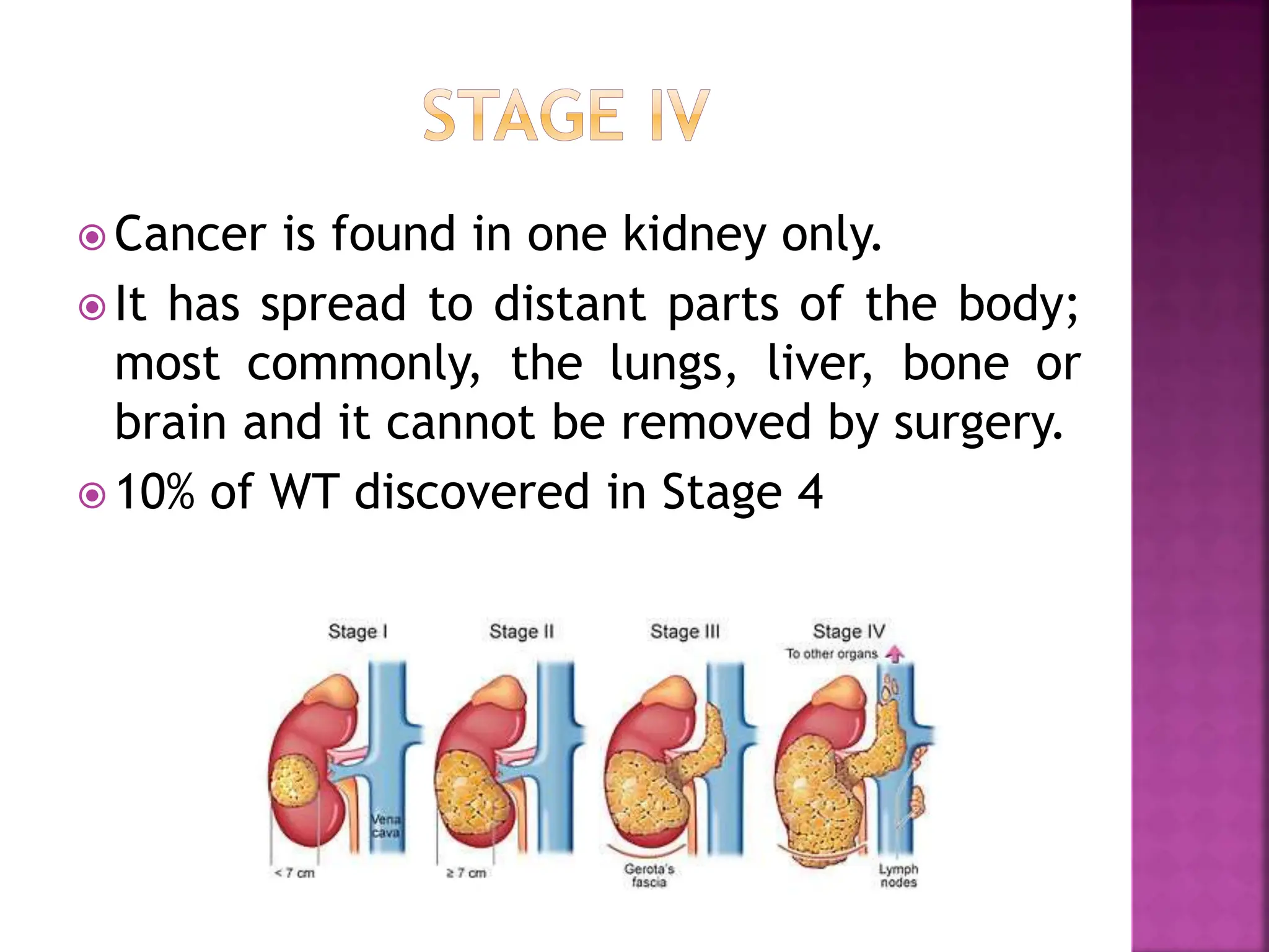 wilms tumor ppt.pptx ppt tumor wilms tumor | PPT
