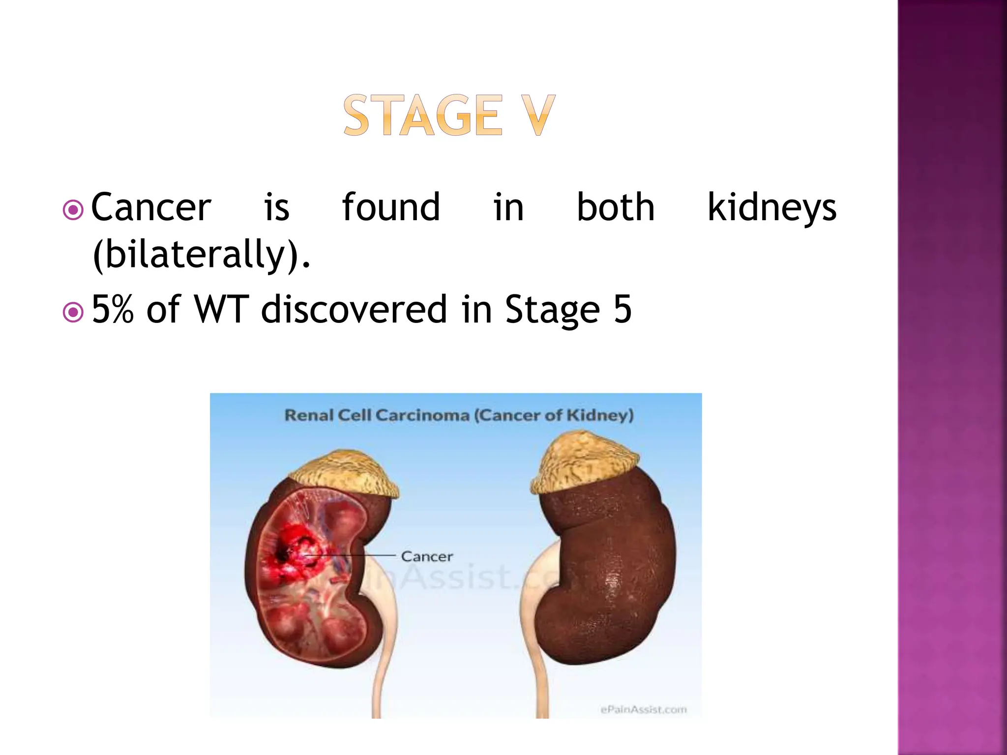 wilms tumor ppt.pptx ppt tumor wilms tumor | PPT
