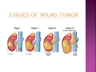 wilms tumor ppt.pptx ppt tumor wilms tumor | PPT