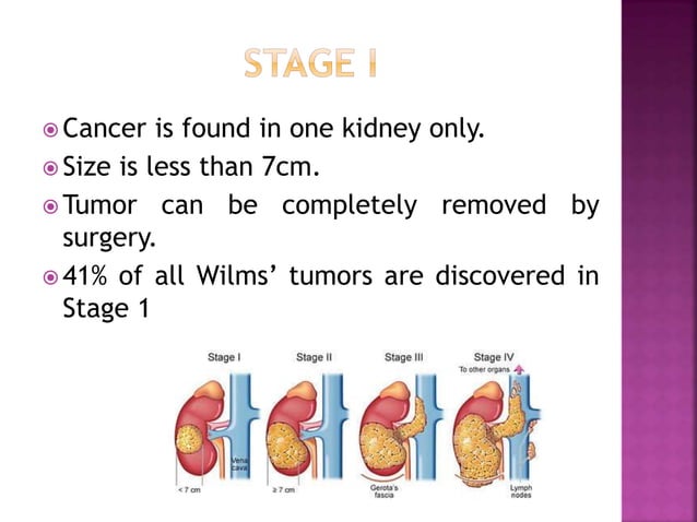 wilms tumor ppt.pptx ppt tumor wilms tumor | PPT