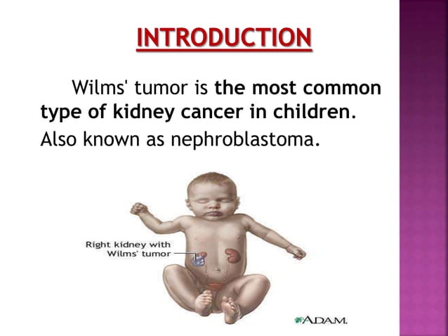 wilms tumor ppt.pptx ppt tumor wilms tumor | PPT