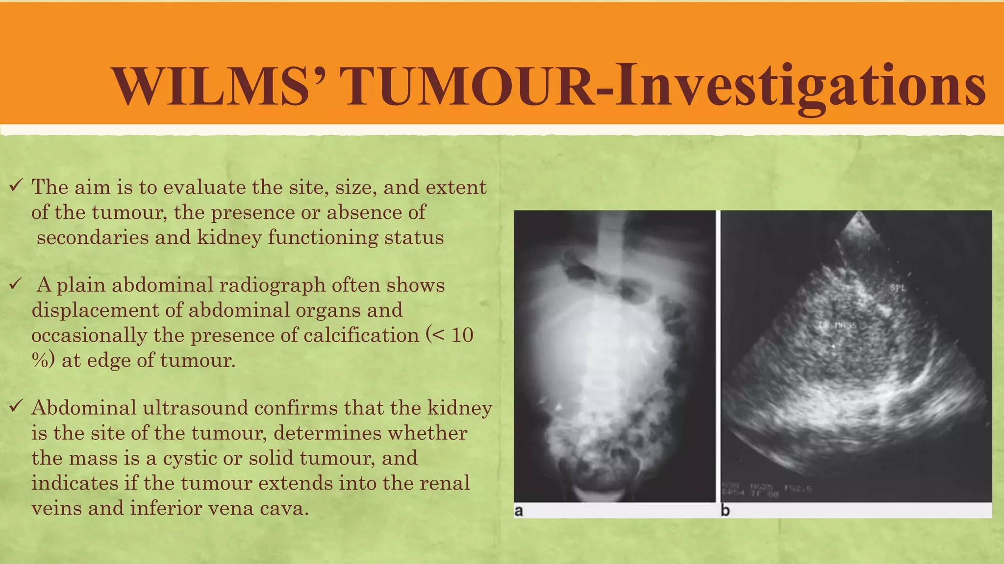 Wilms' tumour-- Pediatric Surgery | PPTX