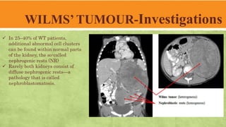 Wilms' tumour-- Pediatric Surgery | PPTX