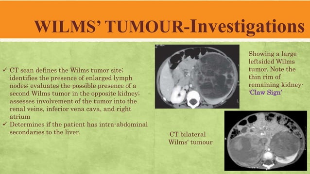 Wilms' tumour-- Pediatric Surgery | PPTX