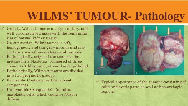 Wilms' tumour-- Pediatric Surgery