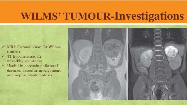 Wilms' tumour-- Pediatric Surgery