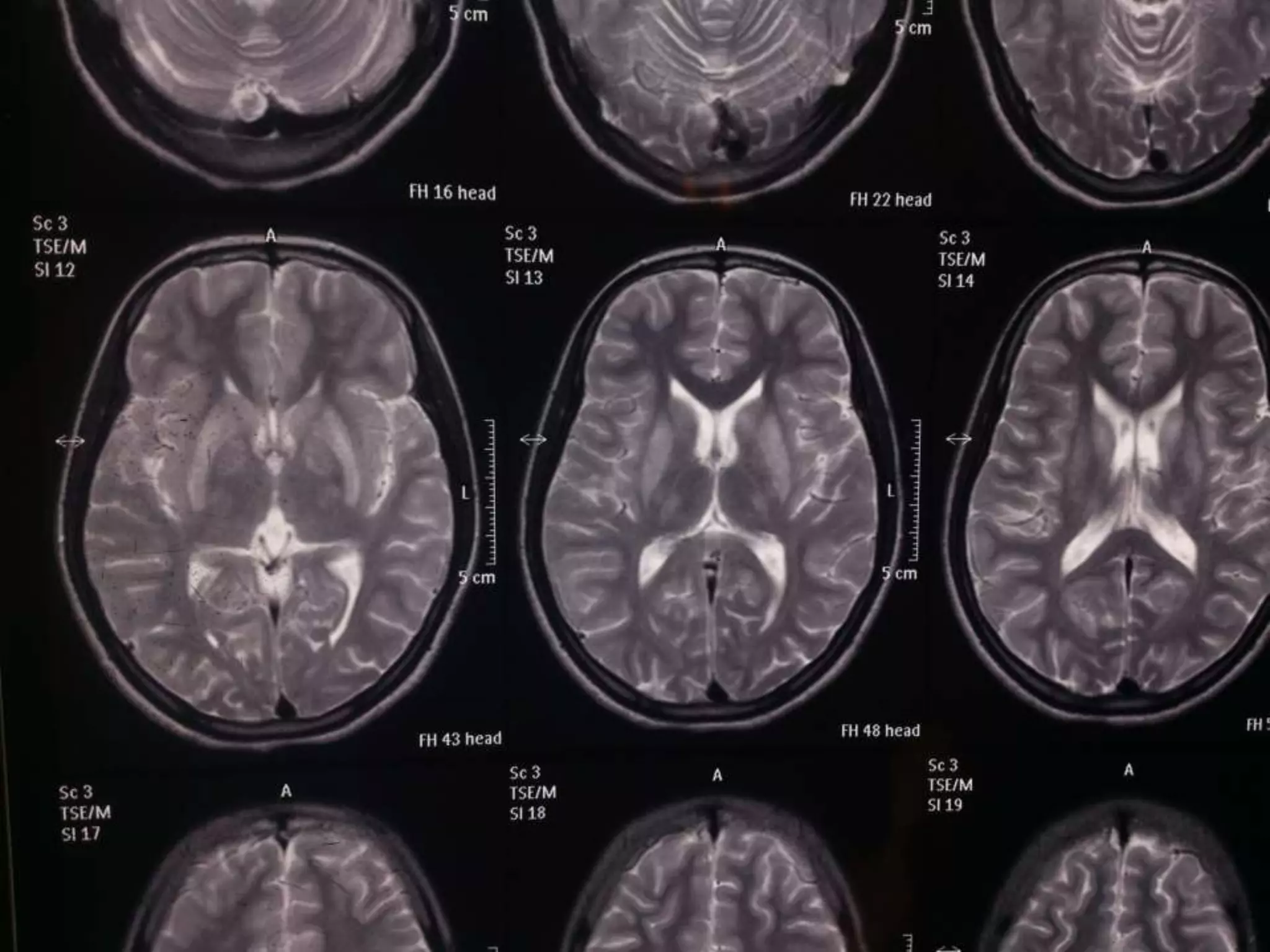 Wilson radiology | PPTX