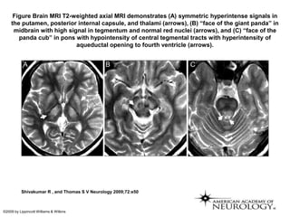 Wilson radiology | PPTX