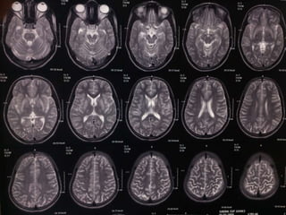 Wilson radiology | PPTX