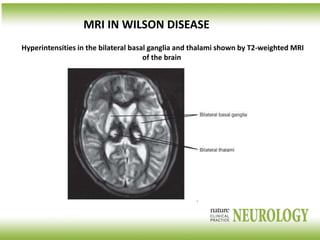 Wilson radiology | PPTX