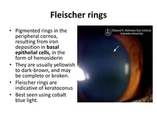 Fleischer Ring Keratoconus