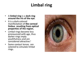 Limbus Sign And Arcus Senilis