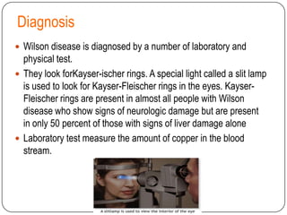 Wilson Disease- Table 5 | PPTX